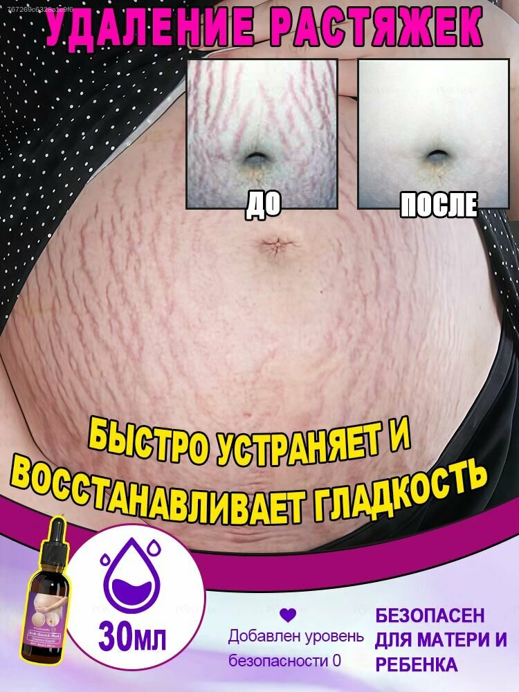 Быстро удаляет растяжки. Антицеллюлитное масло для тела. Подходит для борьбы с морщинами роста, ожирением и послеродовыми морщинками на животе. Нераздражающий.30 мл послеродовых растяжек масло от целлюлита для живота 30мл