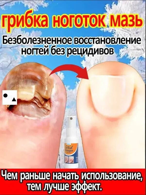 Противогрибковый спрей, от грибка ногтей на ногах, от трещин, для пяток и стоп, мазь от псориаза, зуда, микозе, спрей для ног