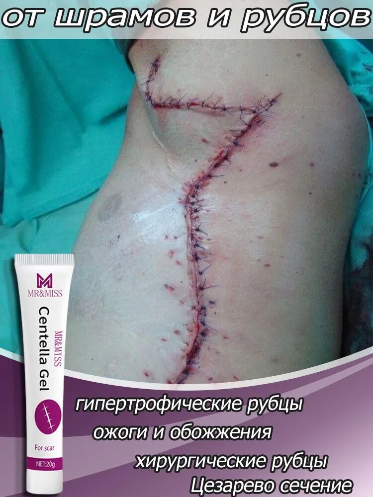 Мазь для удаления рубцов и стрий, подходит для послеродового восстановления, лечения ожогов и гипертрофических рубцов, безследное восстановление, 20 г.
