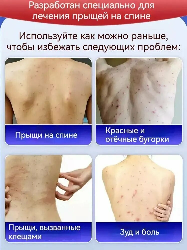 Мазь от чесотка для людей