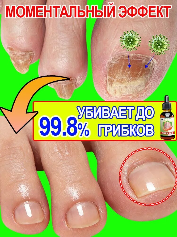 Антибактериальный лак для ногтей. Устраняет грибковые инфекции ногтей на руках и ногах. Эффективно устраняет трещины и отеки, вызванные паронихией. Снимает зуд и восстанавливает ногти. 100 мл