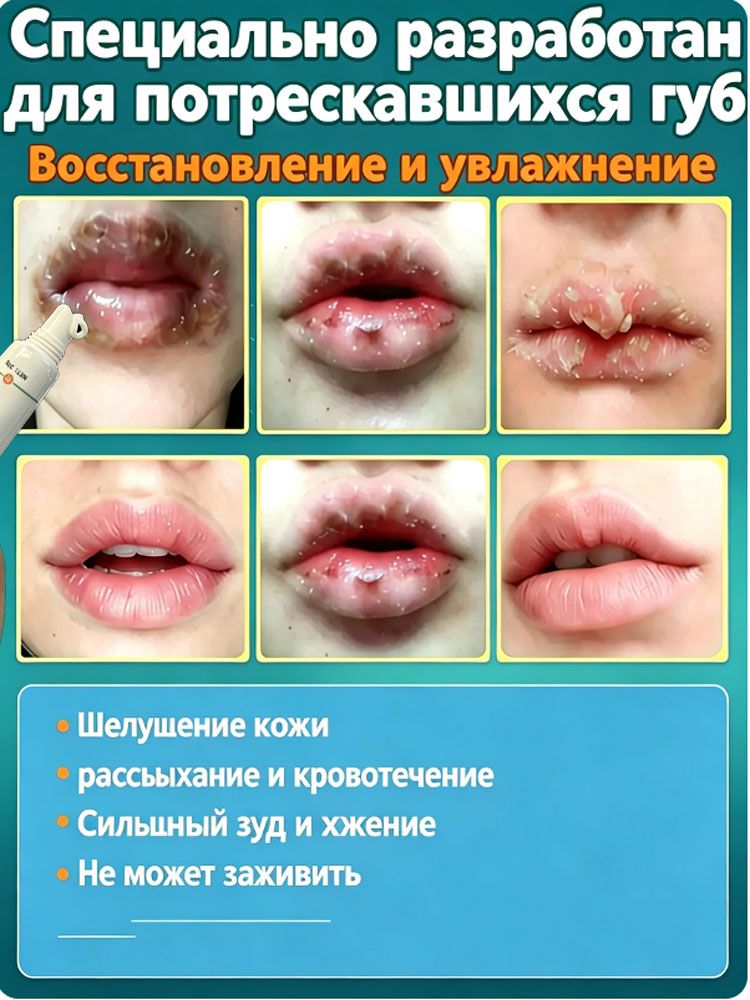 Бальзам для губ Крем для лечения герпеса, хейлита губ, антибактериальная мазь от герпеса, потрескавшиеся губы, морщины