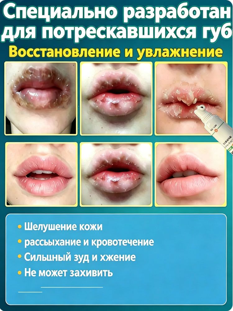 Бальзам для губ Крем для лечения герпеса, хейлита губ, антибактериальная мазь от герпеса, потрескавшиеся губы, морщины
