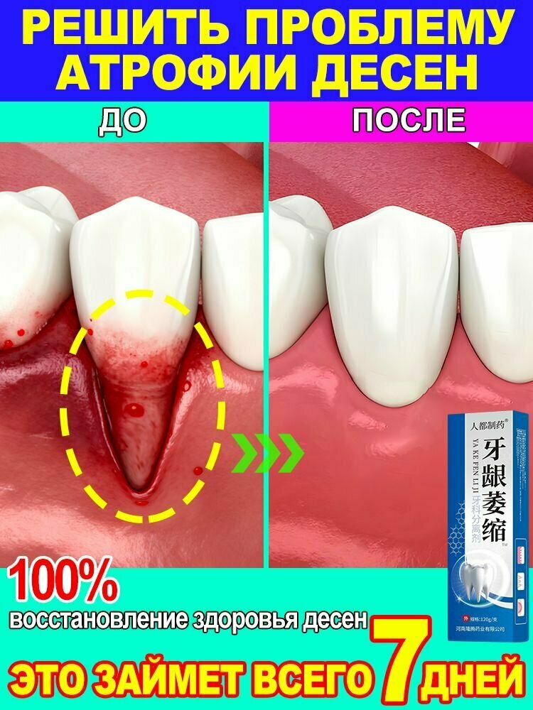Китайская чудо-мазь для лечения атрофии десен, чувствительных зубах и деснах.120г