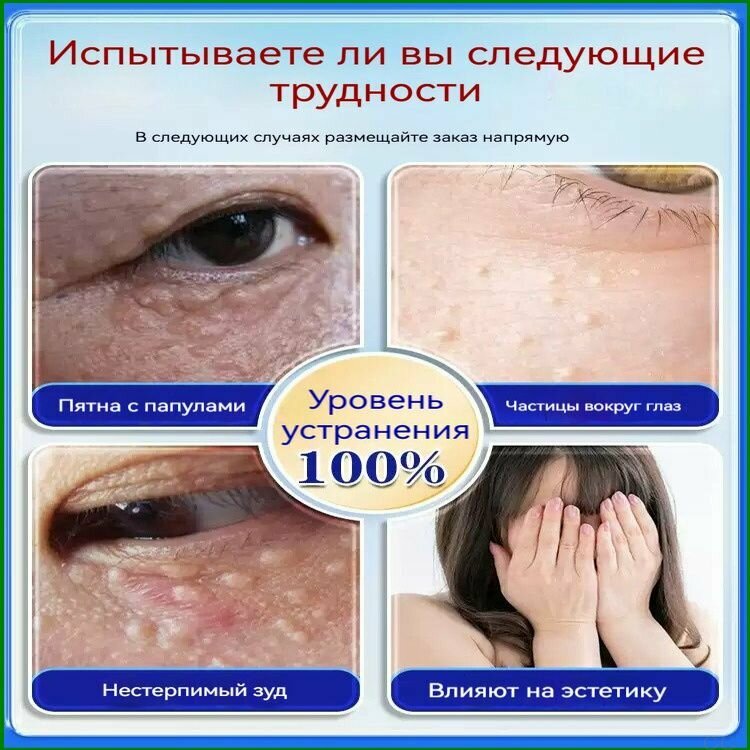 Удаление милиумов под глазами и на веках Быстрое избавление от жировых гранул. Мазь/крем для лечения от милиумов для век удаление жировых гранул