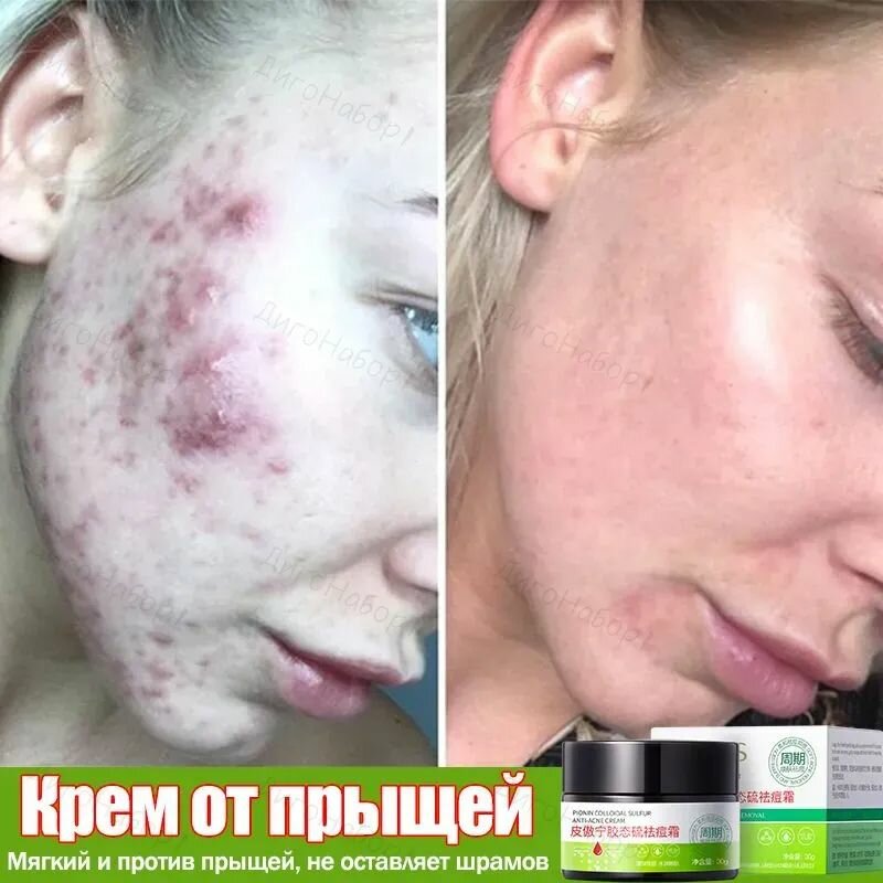 Крем Clear Skin от прыщей 30г с салициловой кислотой для проблемной кожи