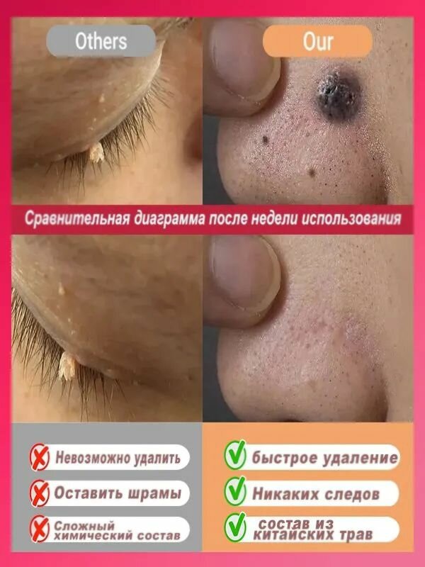 Крем от остроконечных кондилом с травяным комплексом направленное действие и восстановление