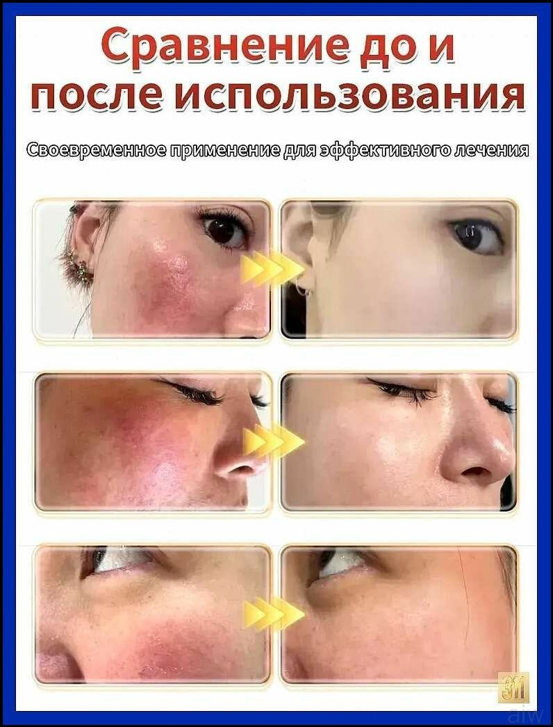 Винная мазь для носа отрозацея и купероза, крем для личения розацеа кожи лица, мазь сосуды носа, Гельтек Гель Демотен Форте от прыщ, крем регенерирующий, 20г