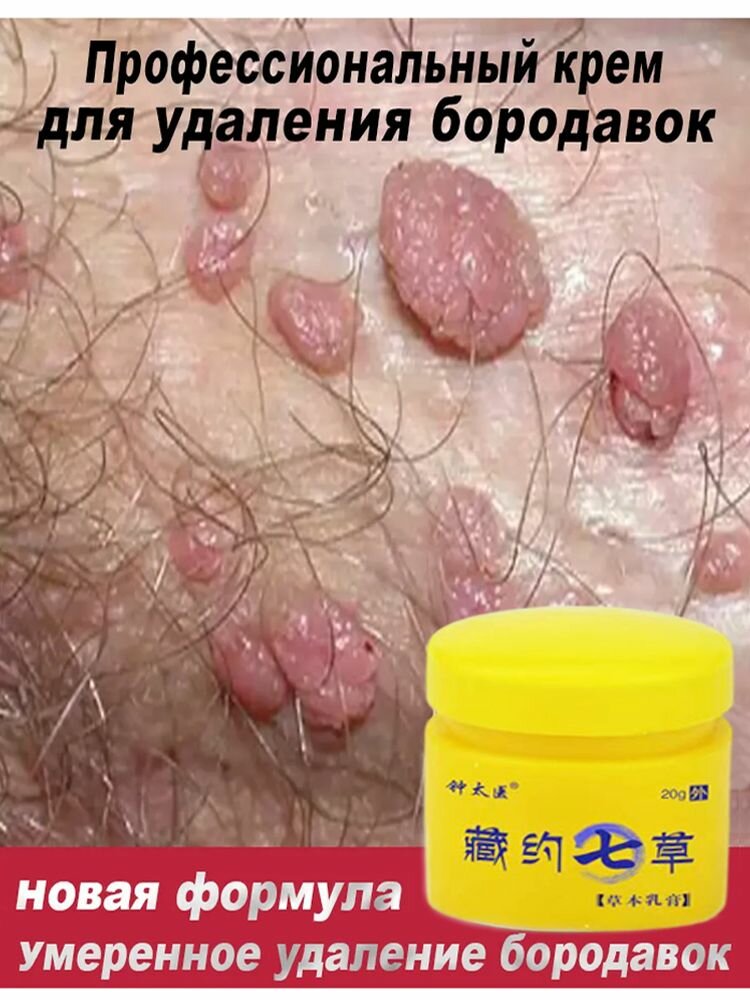 Папилофаг от папиллом — фото 1
