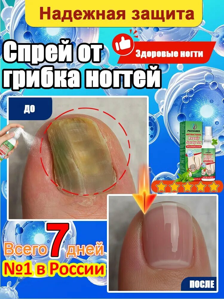 Противогрибковое средство для ногтей быстрый эффект лечение грибка на руках и ногах удаление желтизны и утолщения ногтей30 мл