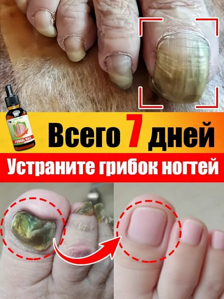 Средство от грибка ногтей на руках и ногах/ Масло от онихомикоза. Противогрибковое , Устранение паронихии восстанавливает ногти. Попрощайтесь с онихомикозом!