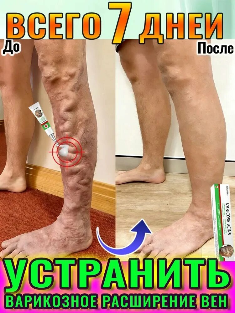 Крем против варикоза и усталости ног: снимает отечность, улучшает кровообращение, питает сосуды и лечит симптомы варикозного расширения вен на всех стадиях.5 упаковка