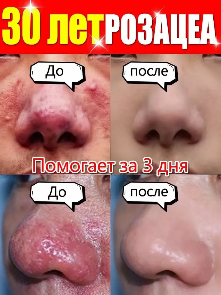 Мазь от розацеа на лице купероза и покраснений, Средство от розацеа, Китайская чудо-мазь для лечения розацеа,20 г