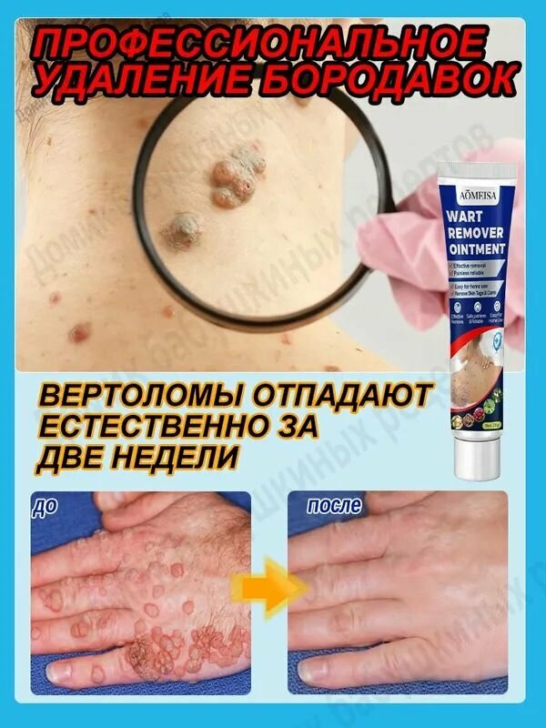 Мазь от бородавок, крем для удаления бородавок, папиллом и родинок, безболезненный, без следов, без побочных эффектов, подходит для всех частей тела.20 мл