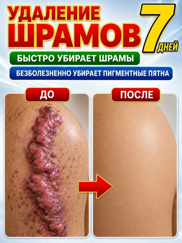 Этот крем от шрамов можно наносить на любую часть тела, он помогает избавиться от растяжек, ожогов и пигментных пятен. Его также можно использовать для лечения шрамов от постакне. 100 мл