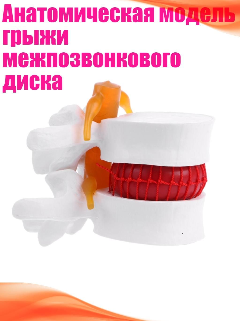 Анатомическая модель грыжи межпозвонкового диска, Белый
