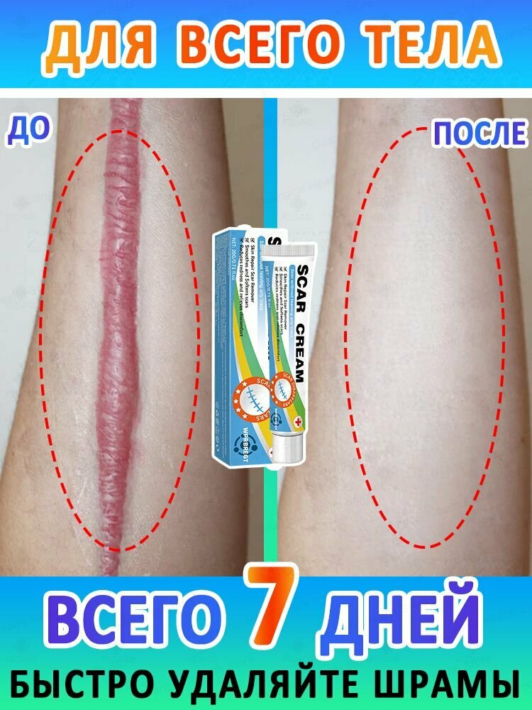 Этот крем для заживления рубцов снимает зуд и быстро удаляет гипертрофические рубцы, ожоги, угри, старые шрамы, растяжки, а также оказывает мягкое и нераздражающее действие.