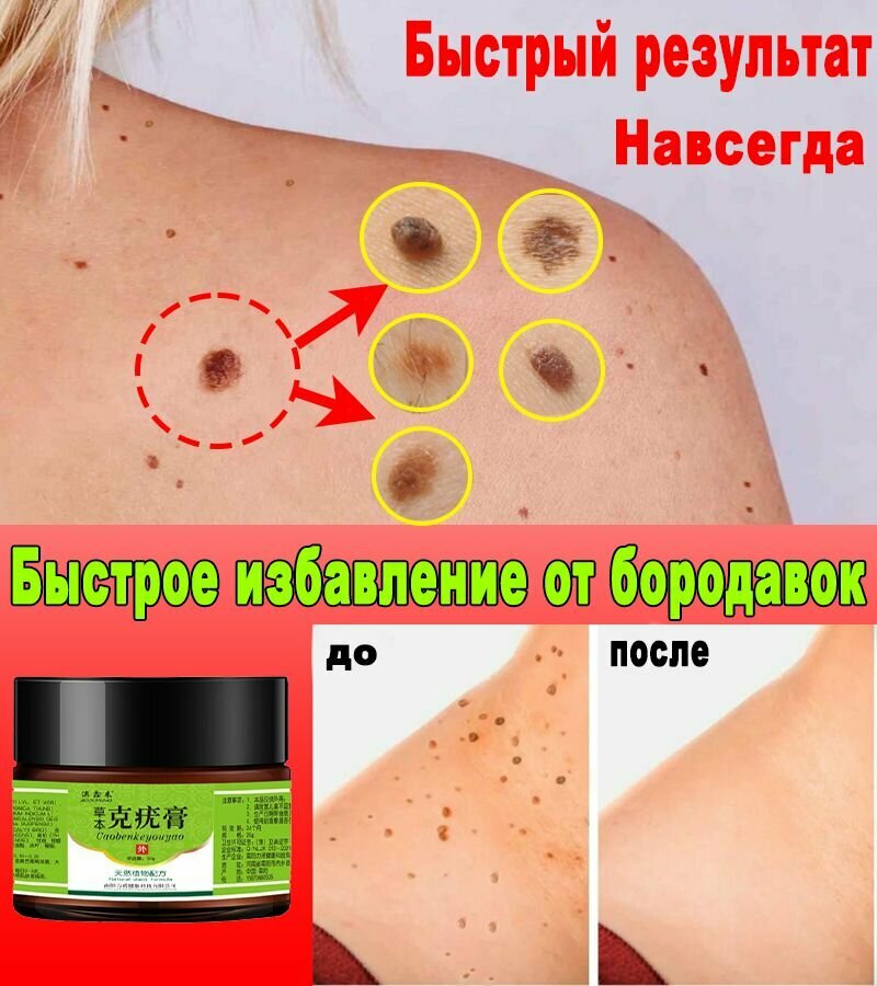 Противобородавочная мазь 20г, Быстрое удаление бородавок и папиллом, Безболезненное устранение наростов, Восстановление кожи, Предотвращение рецидивов, Для всех участков тела.