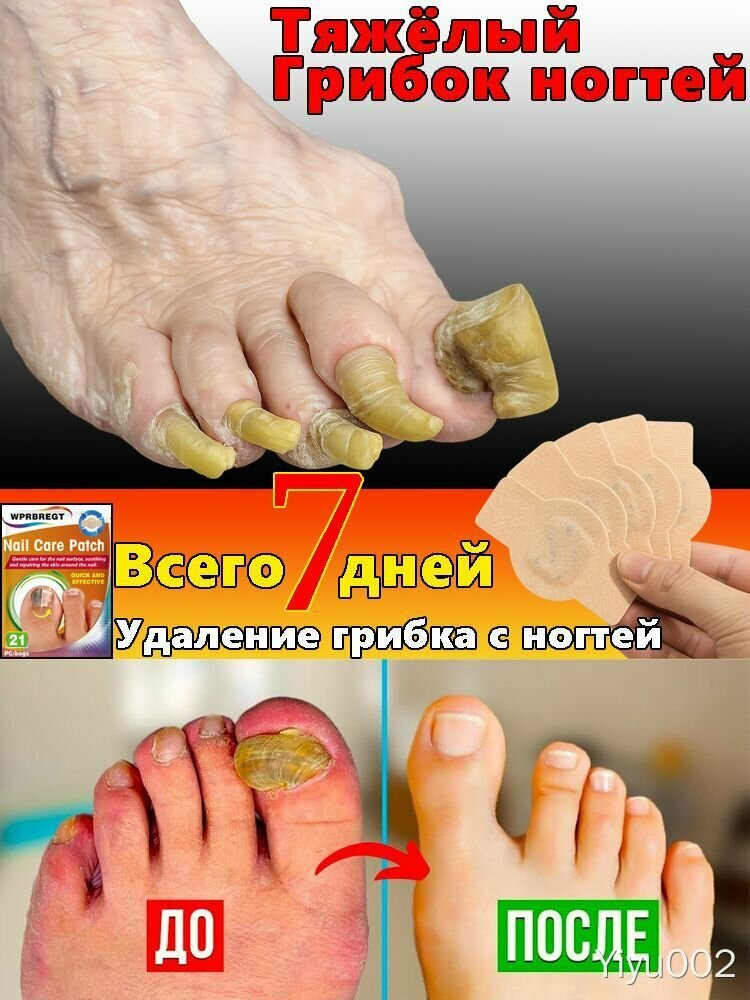 Пластыри от грибка ногтей, 21 шт