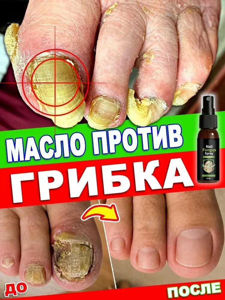 Спрей от грибка ногтей на ногах и руках, противогрибковое средство для лечения онихомикоза и расслоения, укрепляет ногтевую пластину, без запаха и жжения, 30 мл