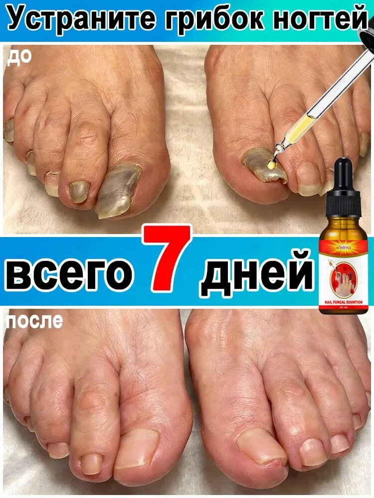 Масло от грибка ногтей для профилактики грибковых инфекций, паронихии, ухода за ногтями и лечения онихомикоза. 10 мл