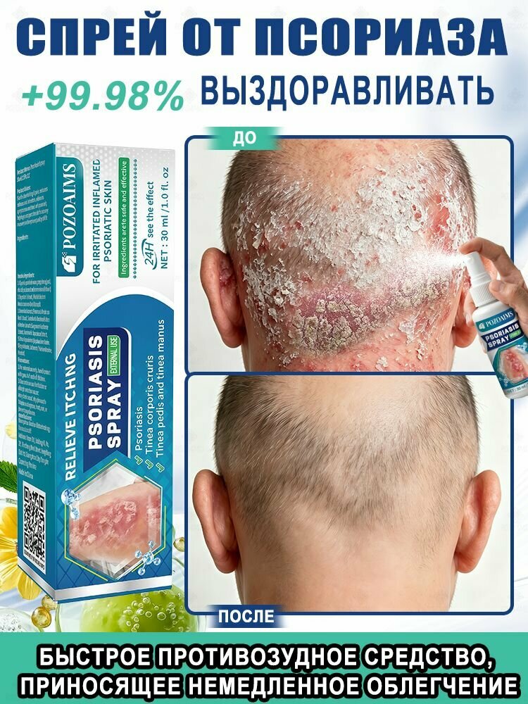 Спрей от псориаза быстро снимает дискомфорт, такой как покраснение, отек, жар и зуд кожи; восстанавливает кожный барьер. спрей от псориаза средство от зуда и покраснения восстановление кожного барьера