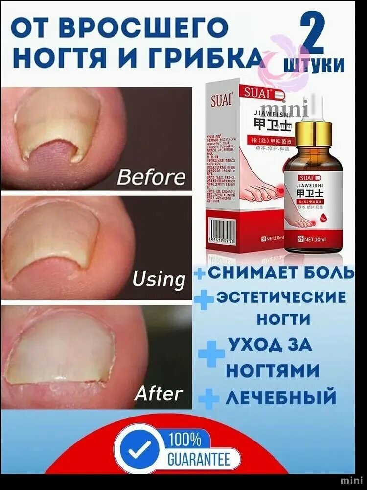 Вросшие ногти на ногах, удаляется масло паронихии, для ухода за ногтями на ногах