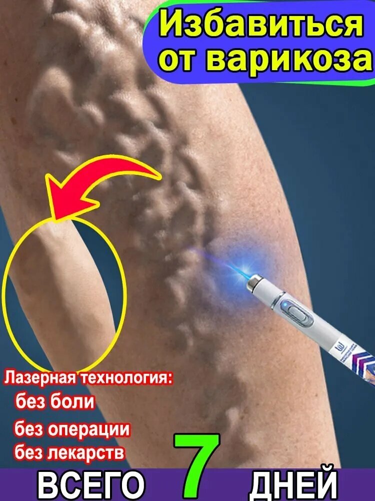 Варикозные вены. Устраняет тромбы, усталость ног и отеки. Способствует венозному кровообращению. Безболезненно и снимает усталость. Один лазерный аппарат.
