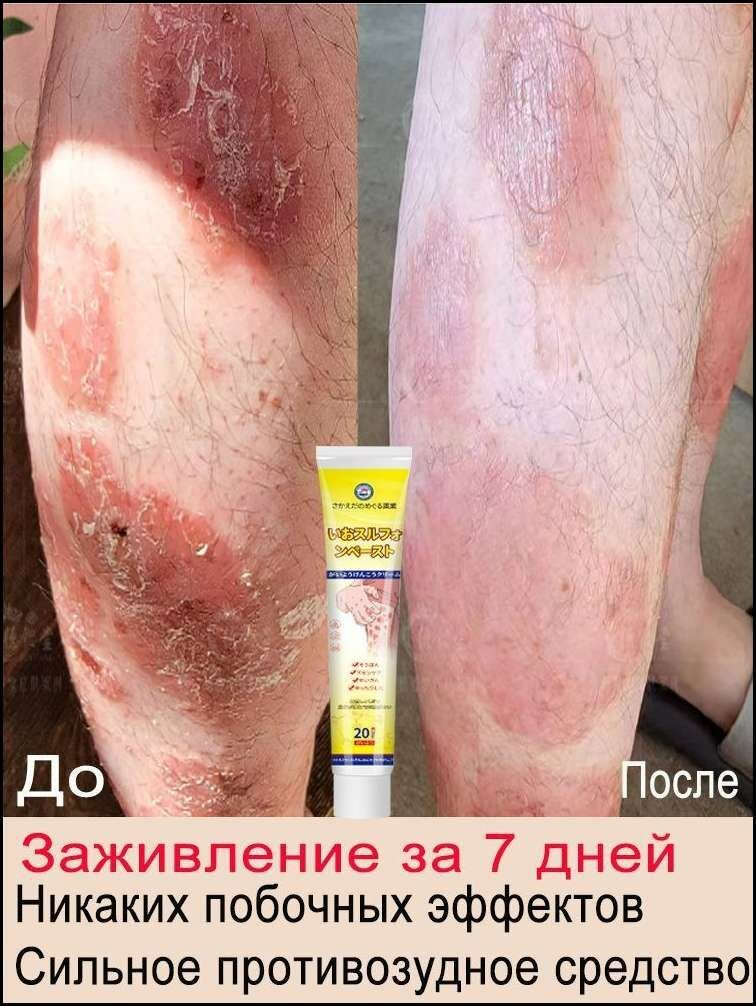 Крем для тела от псориаза Противозудное, антибактериальное средство при экземе и герпесе11