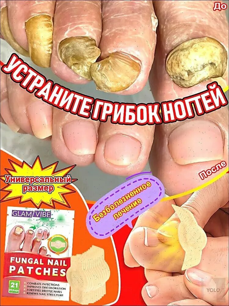 Грибковые пластыри при онихомикозе обеспечивают быстрое лечение онихомикоза на руках и ногах, ухаживают за ногтями, снимают зуд, улучшают паронихий и не вызывают раздражения.63таблетка