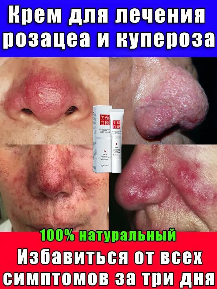 Крем для лица от купероза, розацеа, покраснений "Тонус-Капилляр Лица". для проблемной кожи,100% натуральный В безгормональном составе.20 мл без гормонов натуральный