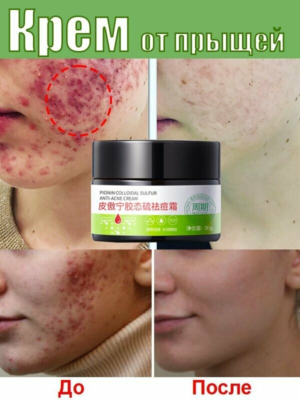 ANTI-ACNE Крем для лица от акне прыщей воспалений 30г, от черных точек и угрей, жирной и чувствительной кожи, Подходит для лица, ягодиц и тела, для подростков и взрослых