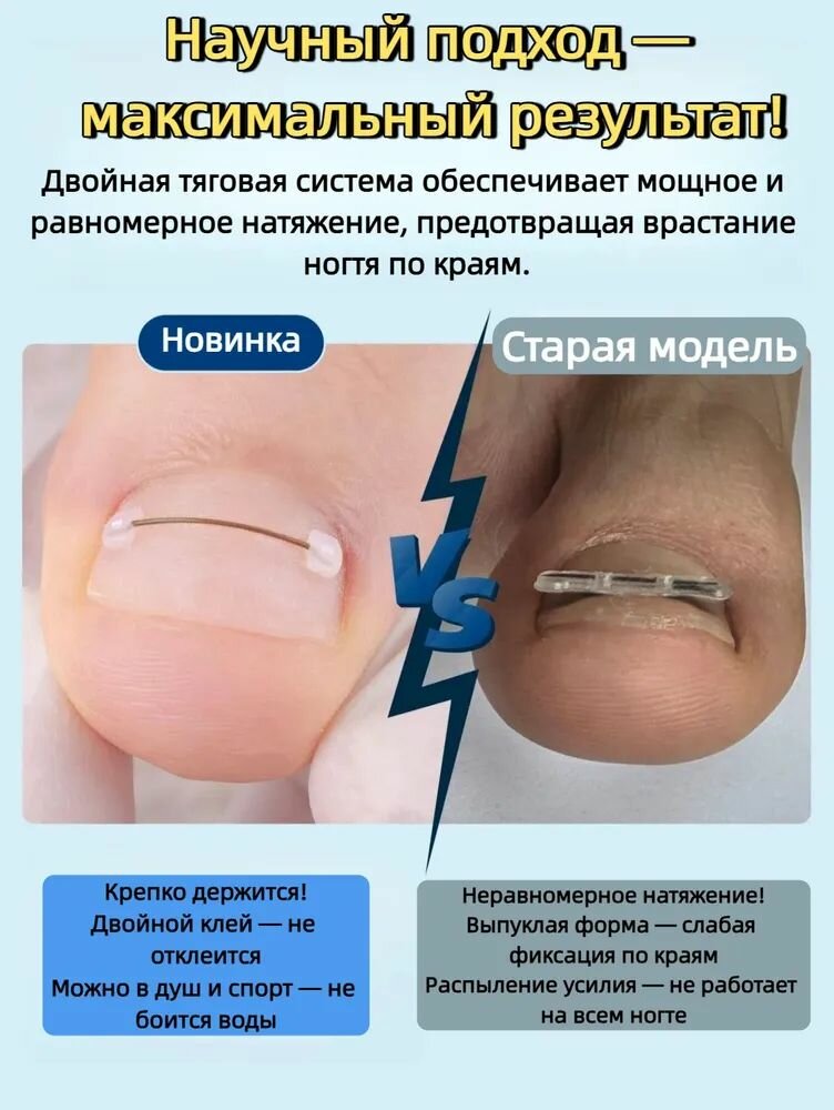 Комплект из 10 никелид-титановых корректоров для вросших ногтей