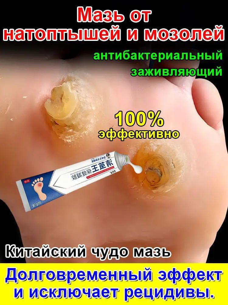 Mазь от мозолей стержневых и натоптышей , Крем от сухих мозолей, шипицы, бородавок, натоптышей,20 г.3шт