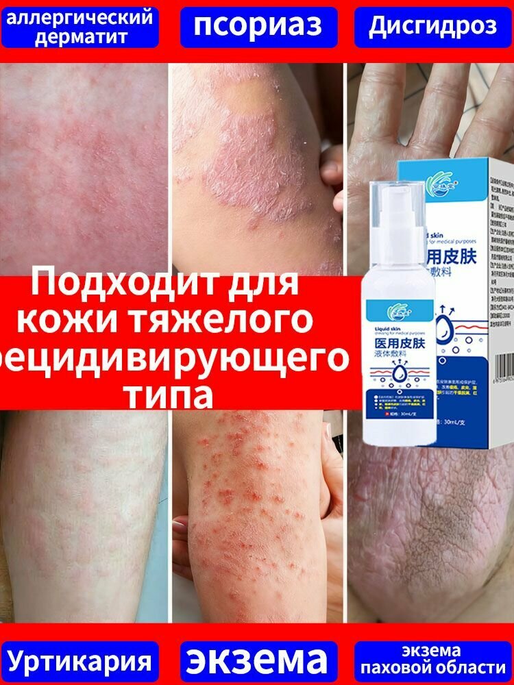 Мазь от псориаза и экземы, от зуда и раздражения кожи при псориазе, экземе, аллергии, контактном дерматите