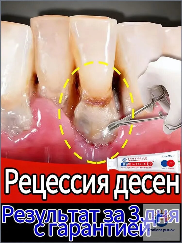 Восстановление десен и укрепление зубов при рецессии - гель с регенерирующим кремнием