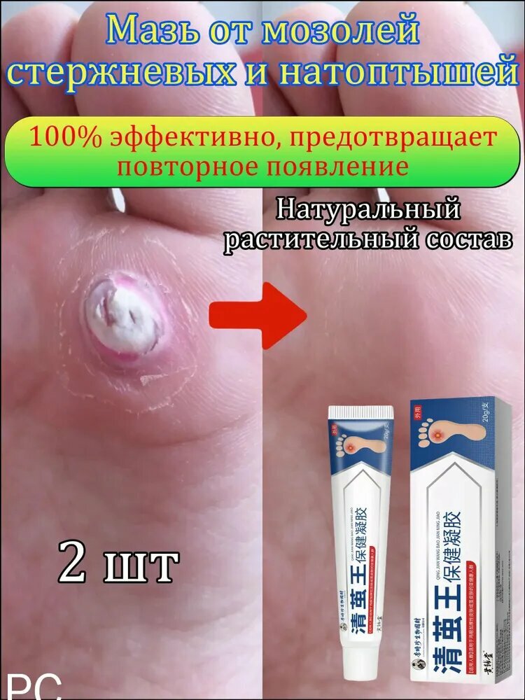 Пластырь от мозолей, бородавок и натоптышей лечебный, быстрое смягчение, безболезненное удаление,20 г.2шт