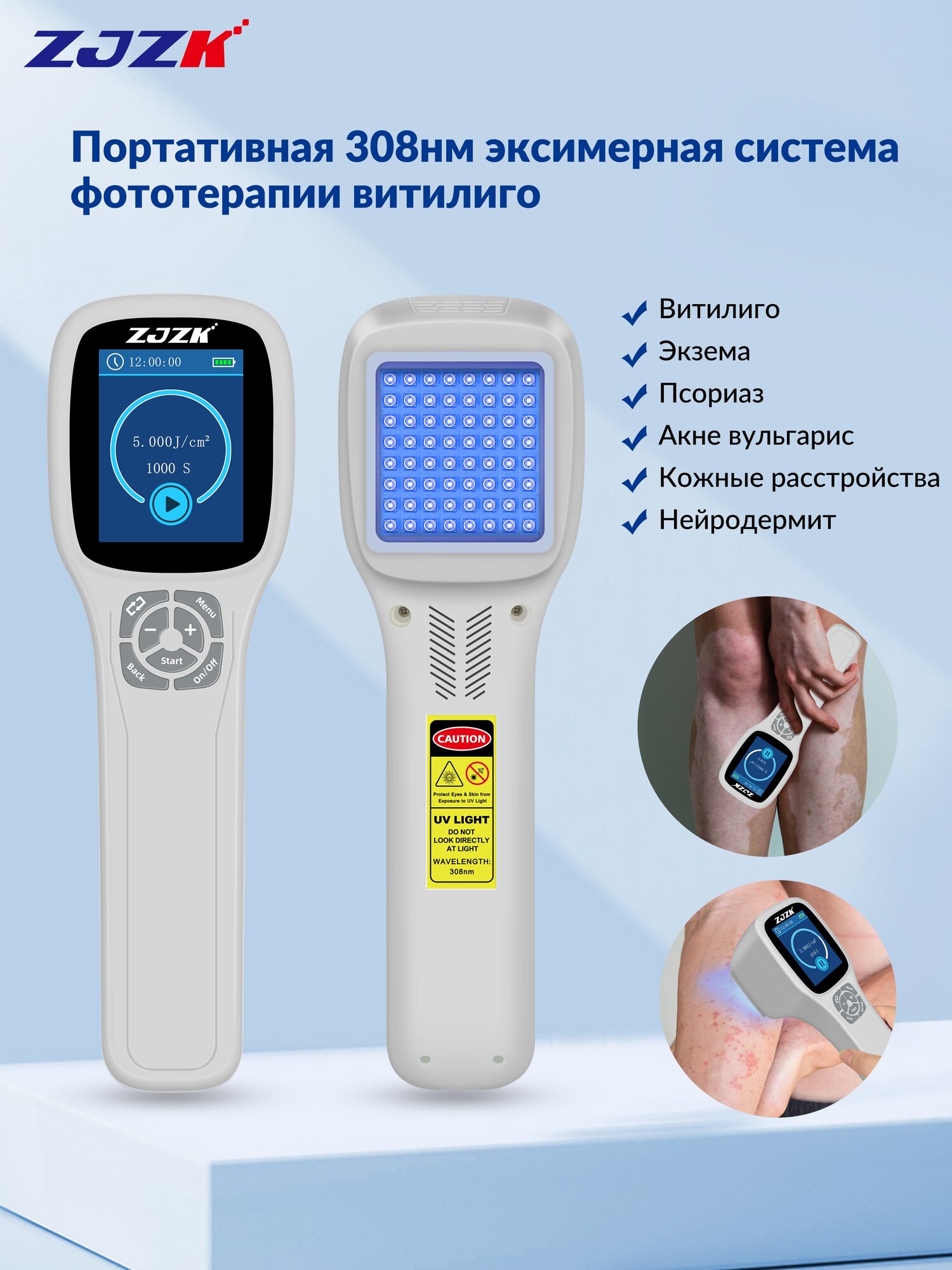 ZJZK 308 нм Ультрафиолетовая терапия (UVB) с использованием эксимерной лампы для лечения витилиго и псориаза