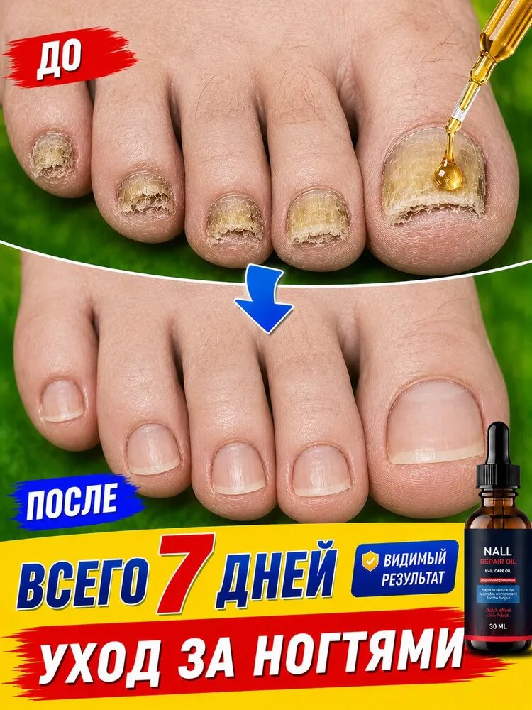 Сыворотка для лечения грибка ногтей и рогового слоя кожи способствует росту и укреплению ногтей, предотвращая их шелушение.30 мл