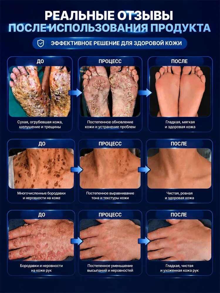 Используется для безболезненного удаления бородавок, папиллом и родинок, не оставляя шрамов.