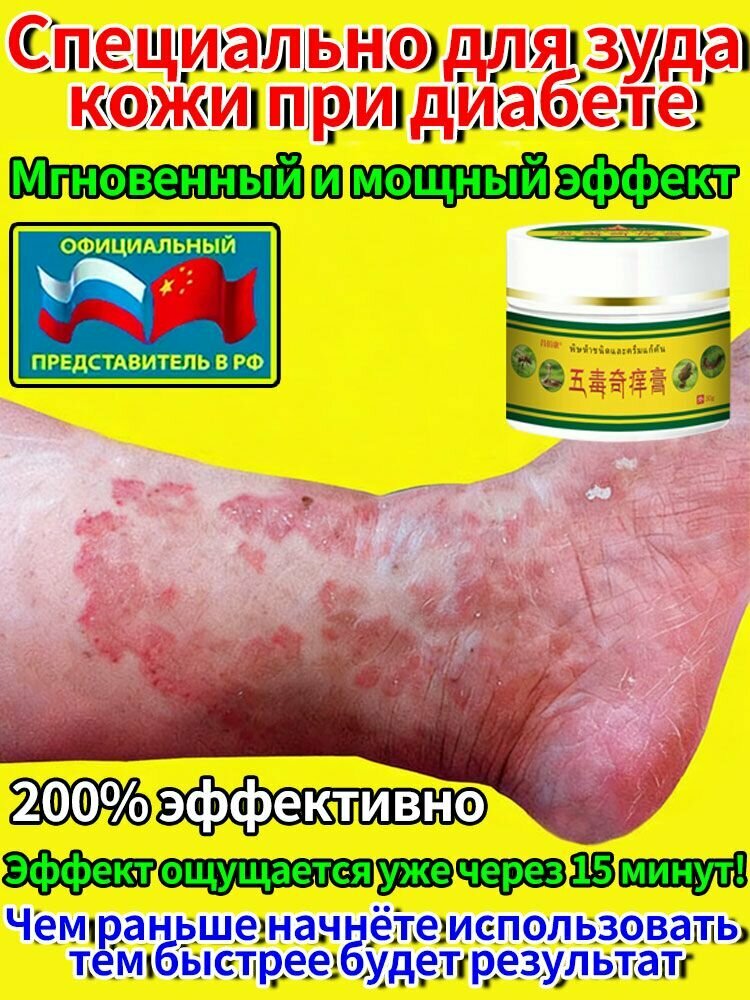 Мазь от кожного зуда при диабете. Быстрое облегчение и восстановление кожи