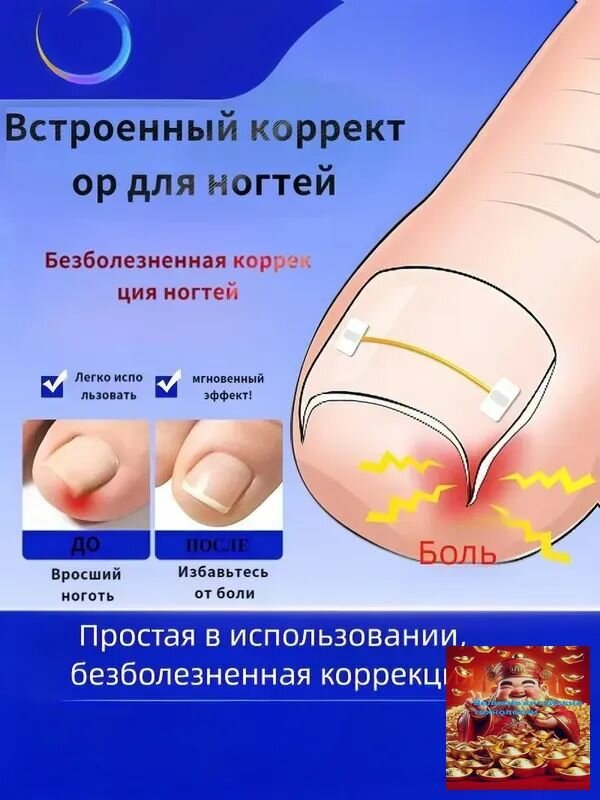 Комплект из 10 никелид-титановых корректоров для вросших ногтей
