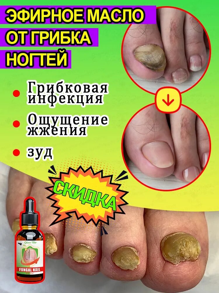 Эфирное масло от грибка рук и ног. Быстро уничтожает грибок, снимает покраснение и отек ногтей, устраняет неприятный запах, мягко проникает в кожу и глубоко подавляет бактерии.