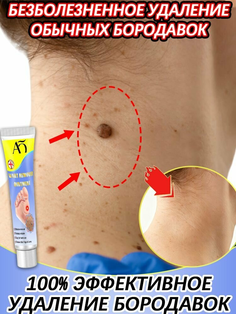 Крем от бородавок: удаляет все типы папилломы, нитевидные, плоские, генитальные, подошвенные и обычные бородавки с любой зоны тела. Действует быстро и бережно.1 упаковка