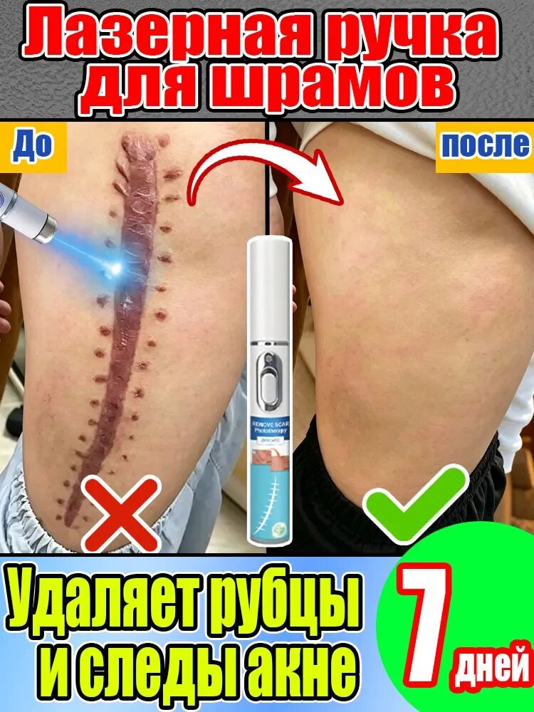 Лазерная ручка от шрамов эффективно удаляет гипертрофические рубцы, следы от угревой сыпи, растяжки и послеродовые раны, осветляет пигментацию и разглаживает кожу. 1 упаковка.