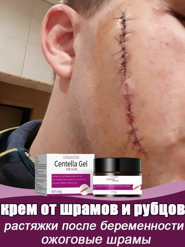 Крем для шрамов и рубцов, предотвращение растяжек, лечение ожогов и шрамов от акне, для тела и лица, 30 г.