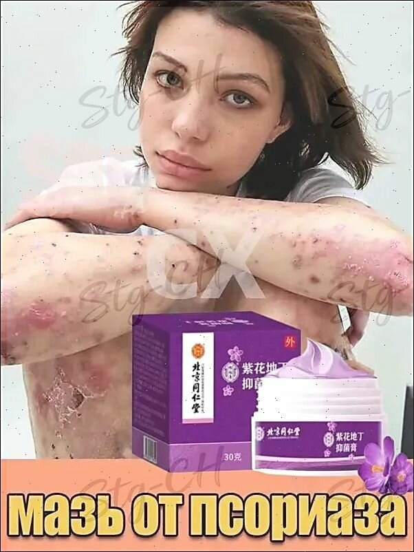 Мазь от псориаза Негормональная мазь от зуда для лечения псориаза, дерматита и экземы, порезов, облегчения зуда, 20 г.