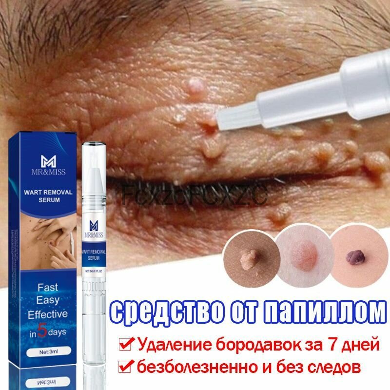 Эссенция для удаления бородавок, папиллом и родинок, безболезненно, без шрамов и побочных эффектов / 3 мл, Быстрое удаление бородавок Нежный от бородавок средство