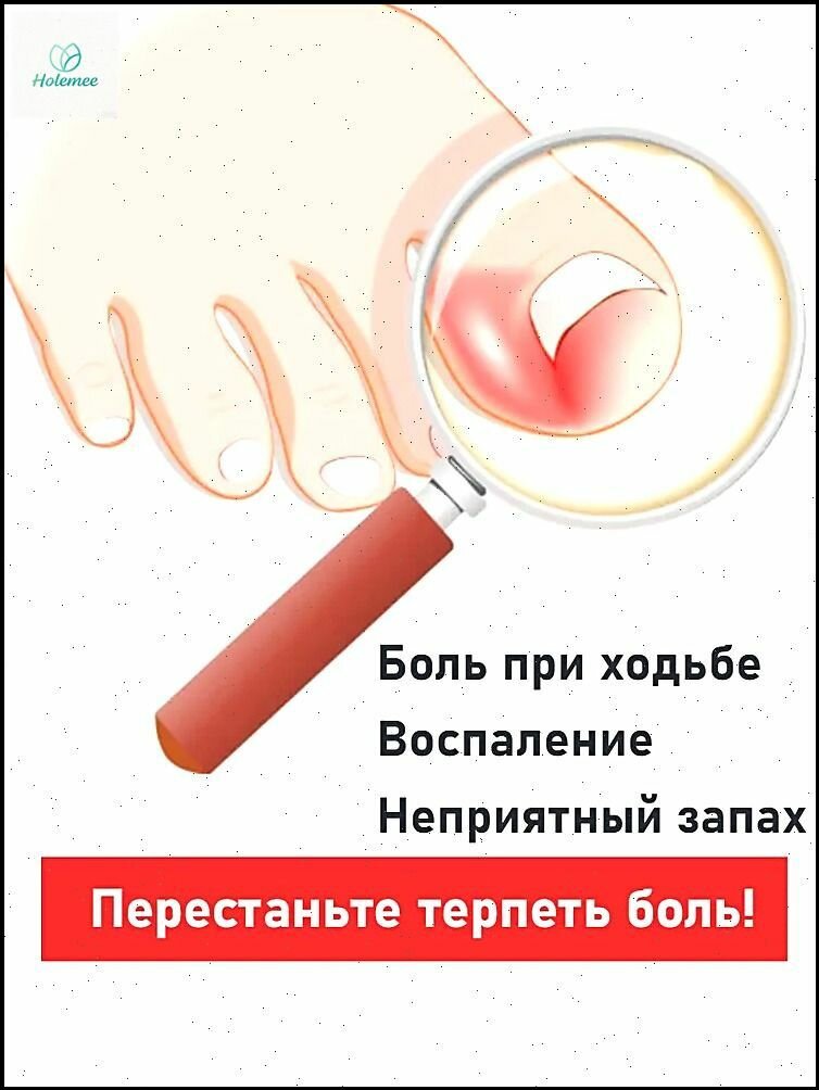 Качественный фиксатор для вросшего ногтя, боль облегчается премиумсредством