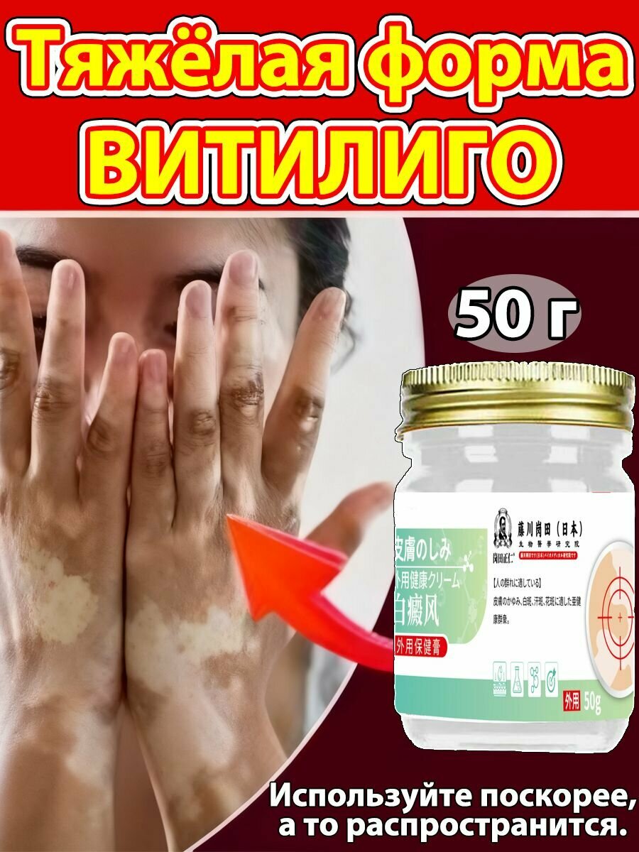 Мазь от витилиго, Средство при нежелательной пигментации витилиго, Мазь для лечения белых пятен на теле,50 г